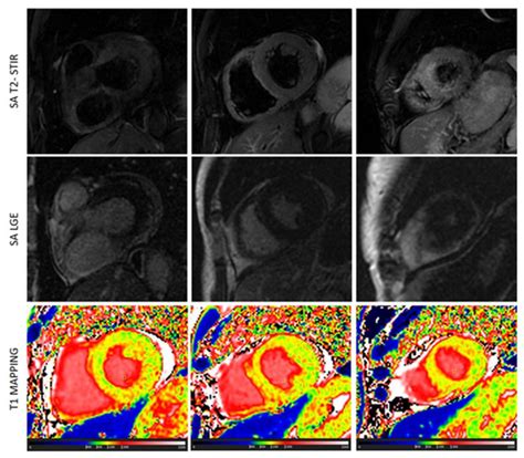 A Case Of Scleroderma With Negative Lge And T2 Stir Image But With A Download Scientific