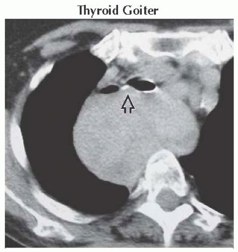 Unilateral Mediastinal Mass Thoracic Key