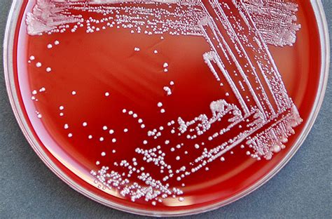 Diphtheria
