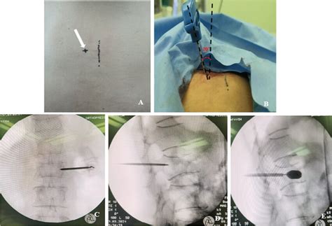 A Unilateral Pkp Skin Incision Design White Arrow Represents The
