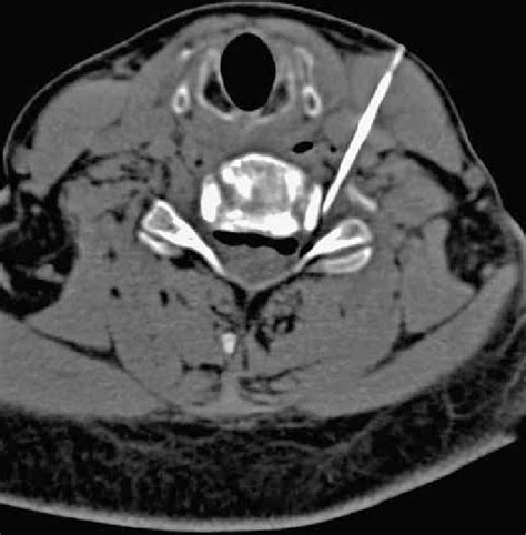 Ct Control After Periradicular Injection And Diffusion Of The O 2 O 3 Download Scientific
