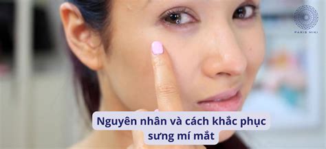 Nguyên Nhân Và Cách Khắc Phục Sưng Mí Mắt