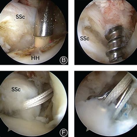 Surgical Procedure Under Shoulder Arthroscopy A Subscapularis Ssc Download Scientific