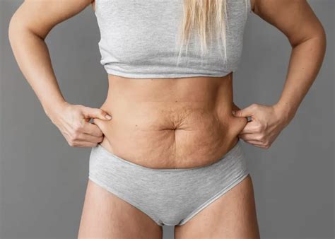Apron Belly Ways To Manage And Reduce Surgisculpt