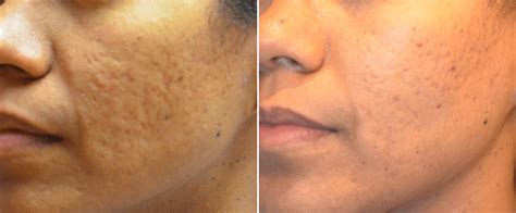 Acne Scars On Black Skin