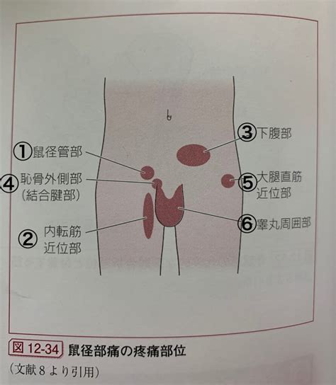 鼠径周辺部痛症候群グロインペイン症状治療リハビリ戦略を解説 リハビリの一助となりますように