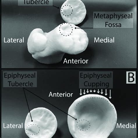 Posterior Epiphyseal Tilt Is Determined By First Drawing A Line Download Scientific Diagram
