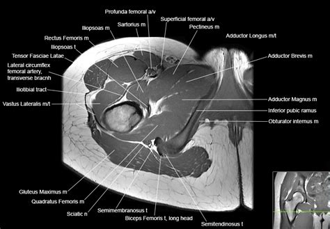 Adductor Muscles Mri