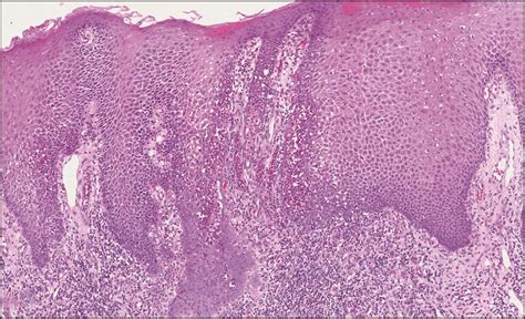 Pyostomatitis Vegetans Histology