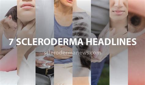 Scleroderma Headlines Scleroderma News Scleroderma Scleroderma Awareness Scleroderma