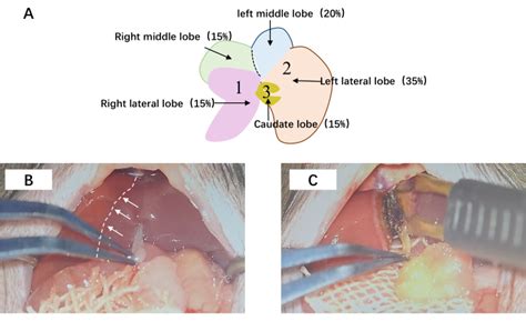 A Mouse Model Of The Associating Liver Partition And Portal Vein Ligation For Staged Hepatectomy