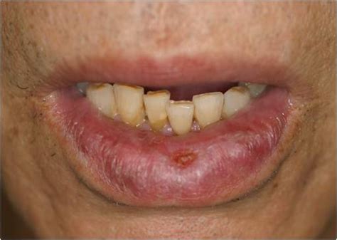 Plasma Cell Cheilitis