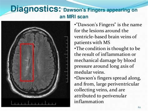 Multiple Sclerosis Adjusted To Publish