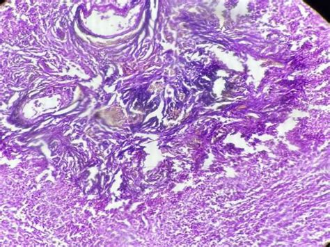 Hyperaemia Congrstion Haemoorhage Cvc Spleen Ppt