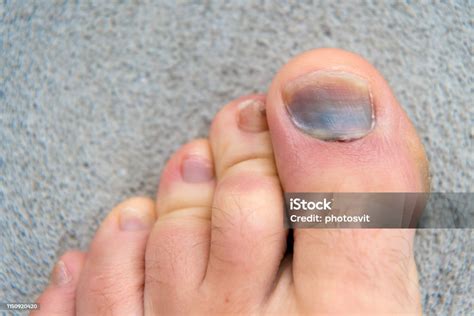 발가락 부상 타 박상 및 외상 치료 의료 개입 골절 불편 한 신발 손톱 곰 팡이 건강 한 발 손가락 혈 종 Desease