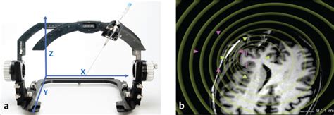 Customized Platform Based Stereotactic Dbs Lead Placement Technique Fhc Starfix Medtronic