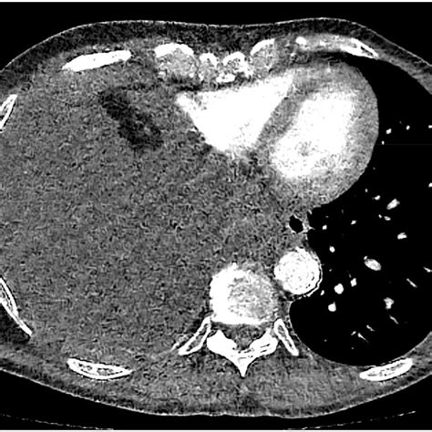 Computed Tomography Of The Chest Axial View Showing Mediastinal Shift