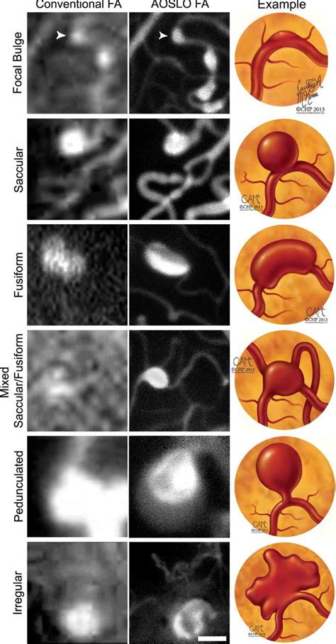 Figure 1 From Classification Of Human Retinal Microaneurysms Using