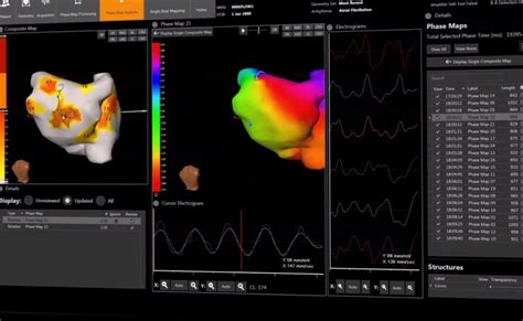 Medtronic Wins Fda Clearance For First Noninvasive Cardiac Electrical