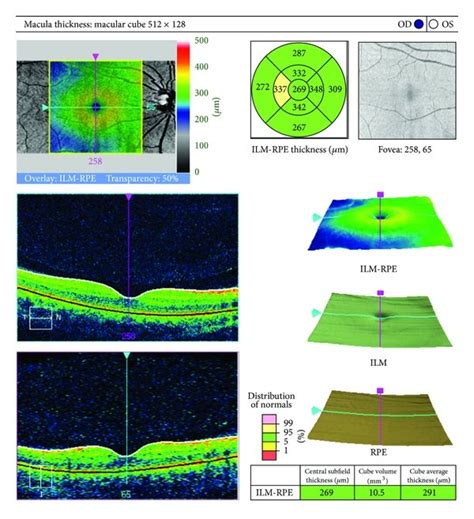 A And B Normal OCT Images Of The Macula Download Scientific Diagram