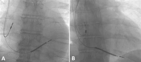 X Ray Pictures In Anteroposterior View A Defibrillation Lead Implanted