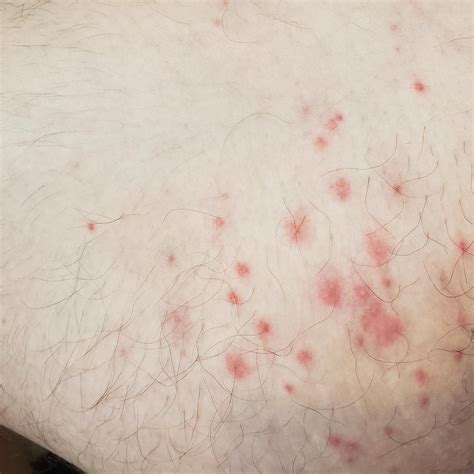 Experience With Isotretinoin Drug Induced Folliculitis R Folliculitis