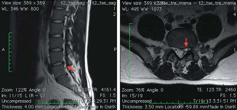 1st Lumbar Spine Cyst