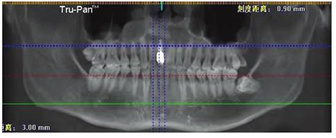 one abutment at one time前牙即刻种植永久基台即刻修复1例 口腔种植临床精萃