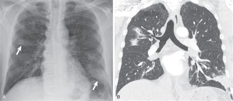 Bacterial Pneumonia Radiology Key