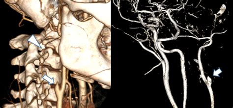 Mr And Ct Angiograms Showed The Complete Occlusion Of The Left Internal