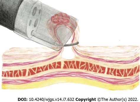 The Cap Assisted Endoscopic Mucosal Resection Technique Download Scientific Diagram