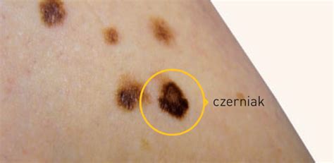 Zwyczajne znamię a może czerniak Wasze Zdrowie