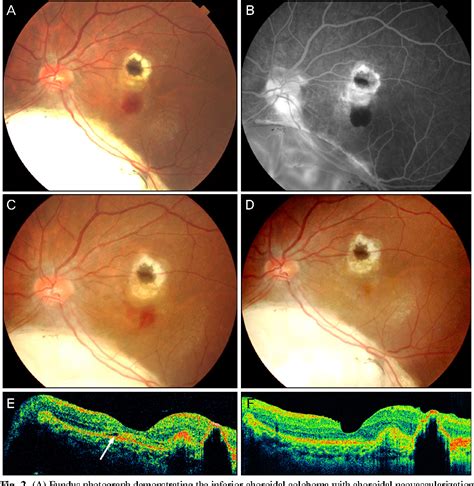 Figure 2 From The Development Of Recurrent Choroidal Neovascularization In A Patient With