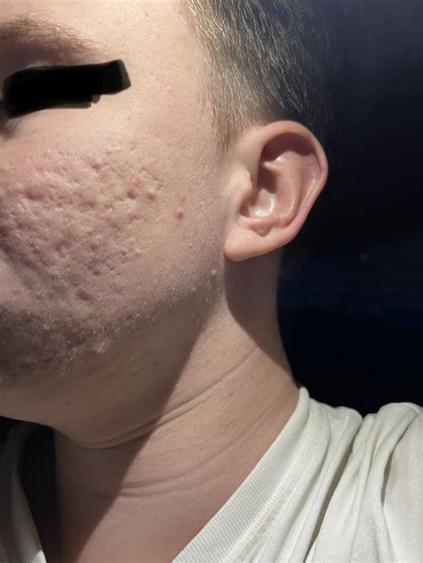 Severe Acne Scarring What Treatments Do I Need Scar Treatments
