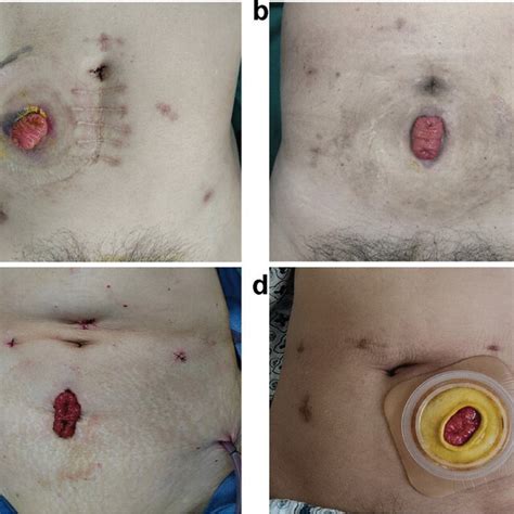 Different Sites Of Protective Loop Ileostomy A Protective Loop