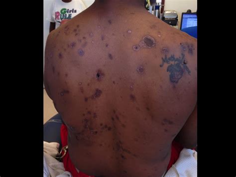 Bullous Pemphigoid And Pemphigus Vulgaris Dermatology Advisor