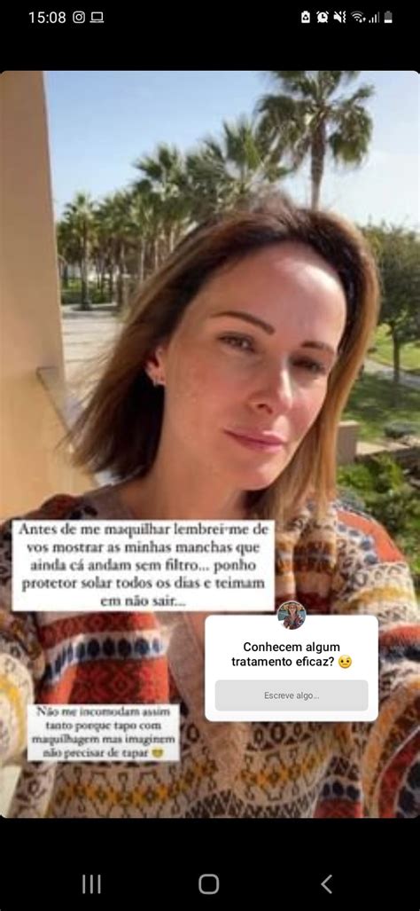 Teimam Em Não Sair Helena Costa Mostra Manchas No Rosto E Pede Ajuda