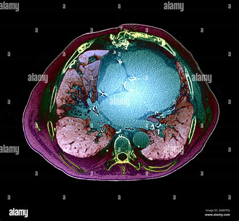 Cardiac Decompensation Coloured Computed Tomography Ct Scan Of An Axial Section Through The