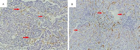 Figure 1 From Correlation Between The Stromal Activated Hepatic