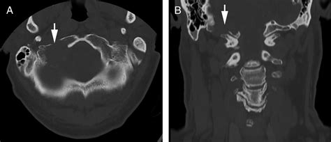 A Solitary Skull Base Plasmacytoma Mimicking Paraganglioma O