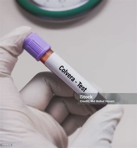대장암이라고도 하는 대장암 진단을 위한 Colvera 혈액 검사를 위한 혈액 샘플 개념에 대한 스톡 사진 및 기타 이미지