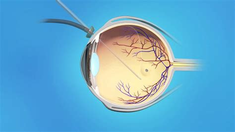 Cataract Surgery After Vitrectomy For Macular Hole At Eleanor Noel Blog