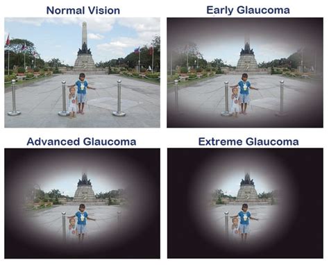 Glaucoma Oasiseye Specialists