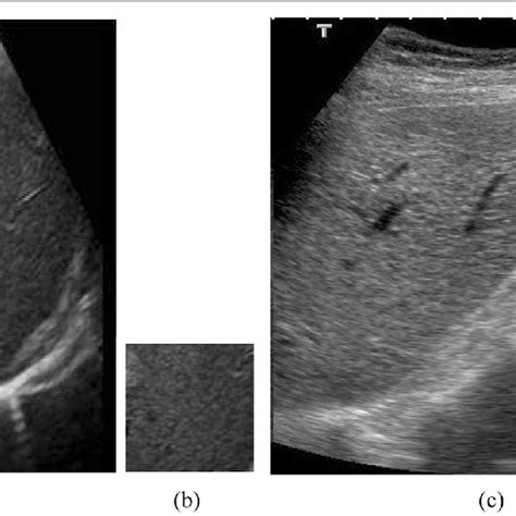 A Us Image Of Normal Liver B Roi From Normal Liver C Us Image Of