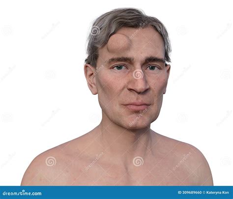 Lipoma On A Man S Forehead 3d Illustration Stock Illustration
