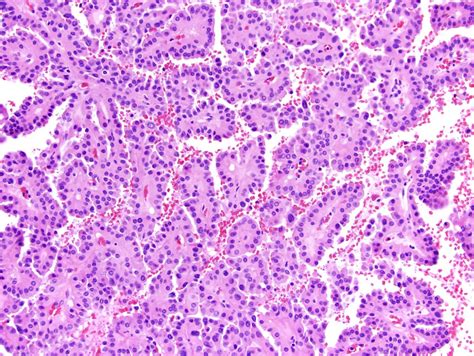 Pathology Outlines Adult Papillary Renal Tumor With Oncocytic Cells