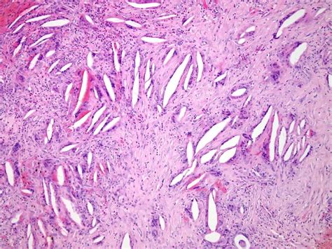 Infected Hydrocele