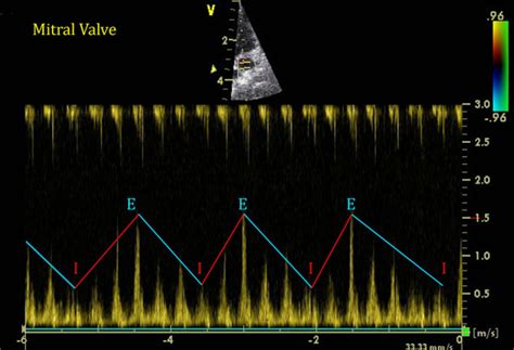 Doppler Echocardiographic Diagnosis And Surgical Therapy Of