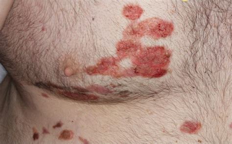 1 4 Autoimmune Skin Diseases Flashcards Quizlet