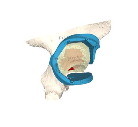 人工髋关节假体截骨导向器 3D Side